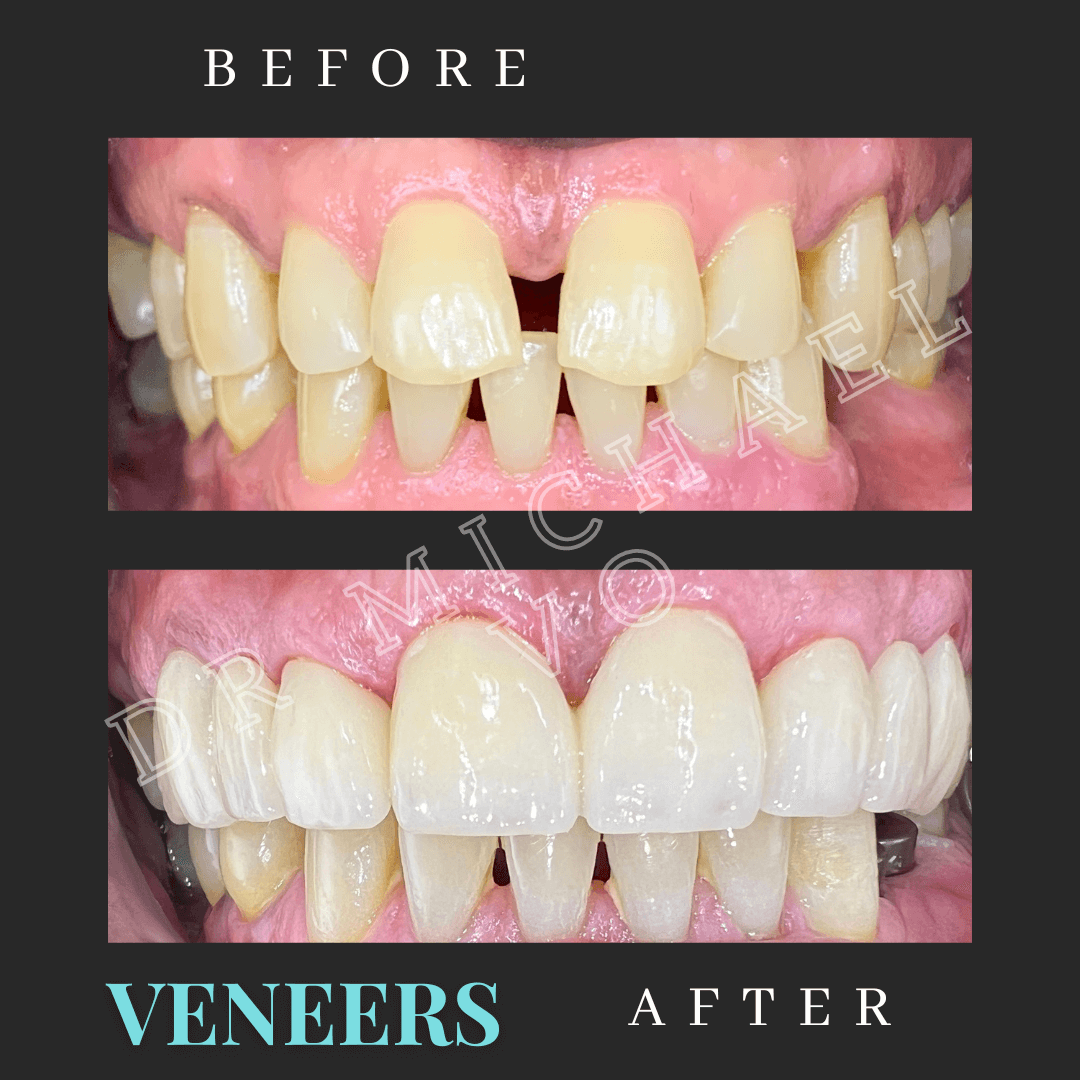 Cosmetic Veneers - West Island Dental Clinic