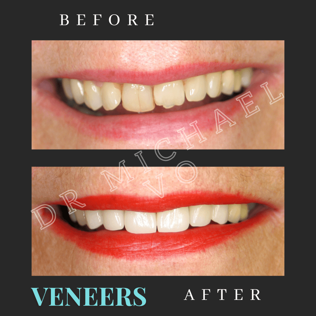 Cosmetic Veneers - West Island Dental Clinic